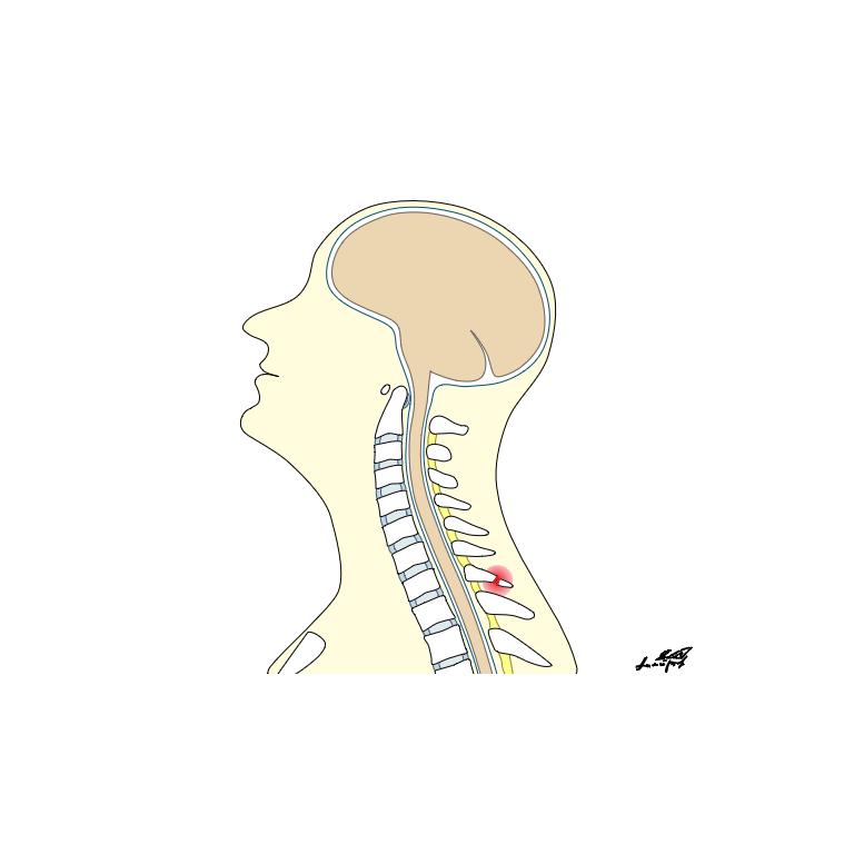Clay-shoveler fracturediagnosis and treatment